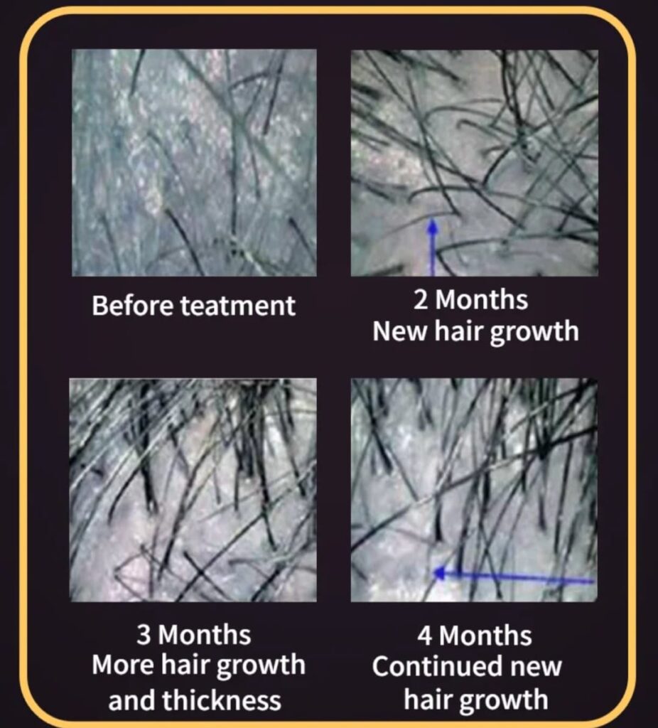6 in 1 Hair Growth System - SkinSoft
